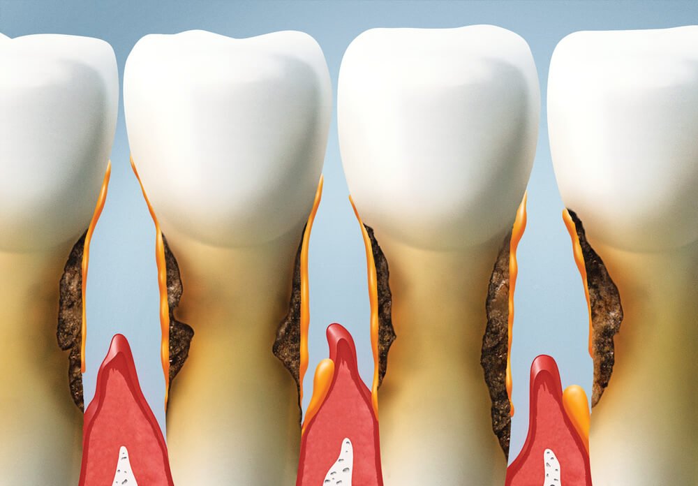 Parodontologija – MyDentalOffice